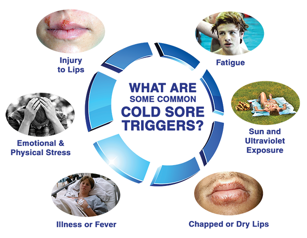 Smile, don't kiss! How to prevent cold sores.